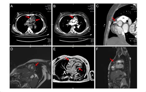 Idiopathic Constrictive Pericarditis With Restrictive Vertical Double