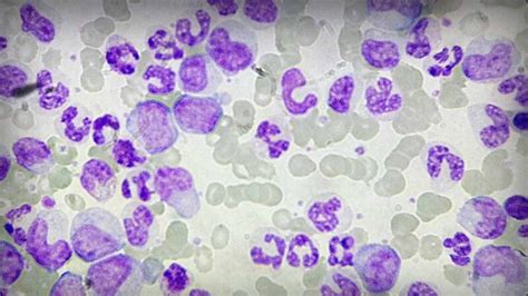 Therapies For Chronic Myeloid Leukaemia Bench Side Story