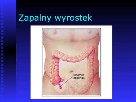 Ostre Zapalenie Wyrostka Robaczkowego