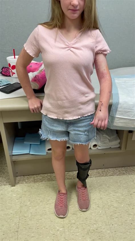 Hyperselective Neurectomy Video 2a