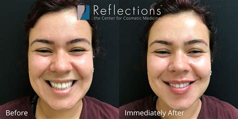 Kysse Lip Filler Results For Young New Jersey Woman Before And After