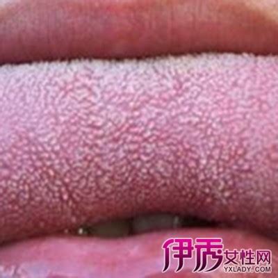 感染了hiv初期症状 hiv感染尚未进入发病期的人称为 随意云