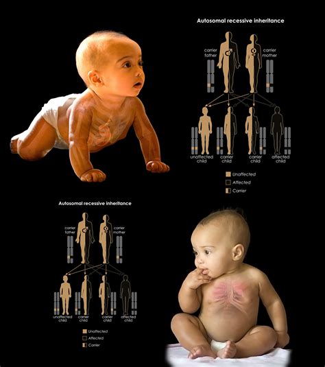 How Is Cerebro Costo Mandibular Syndrome Inherited Storymd