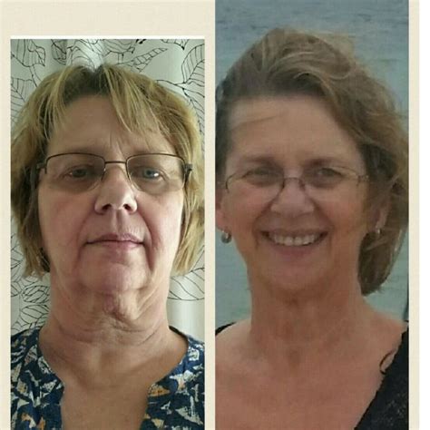 Hypothyroidism Symptoms Before And After