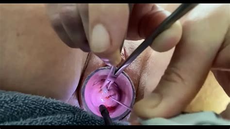 Rosebud Fucks Uterus While Tenaculum Pulls Traction Xxx Mobile Porno