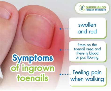 What Causes Ingrown Toenails Symptoms And Treatment Intouchmedicare