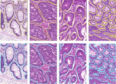 The Colon Gland Segmentation Result Contour Colors Yellow Manual