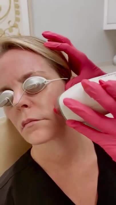 Anti Aging Fraxel Dual Laser Video Realself