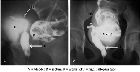 Ambiguous Genitalia Ultrasound