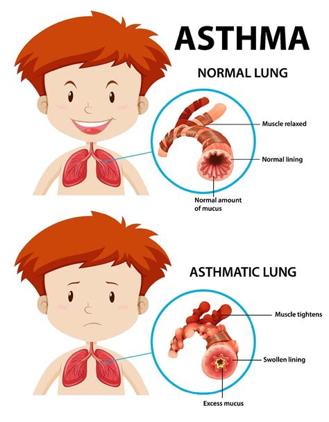 Human Anatomy Asthma Diagram Stock Vector Image Art A