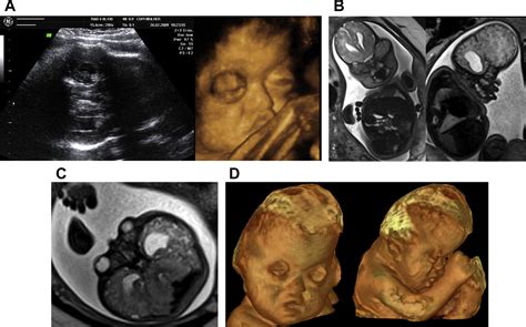 Mr Imaging Of Fetal Musculoskeletal Disorders Magnetic Resonance
