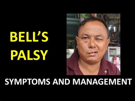 What Is Bell S Palsy How Long Does It Take To Recover YouTube