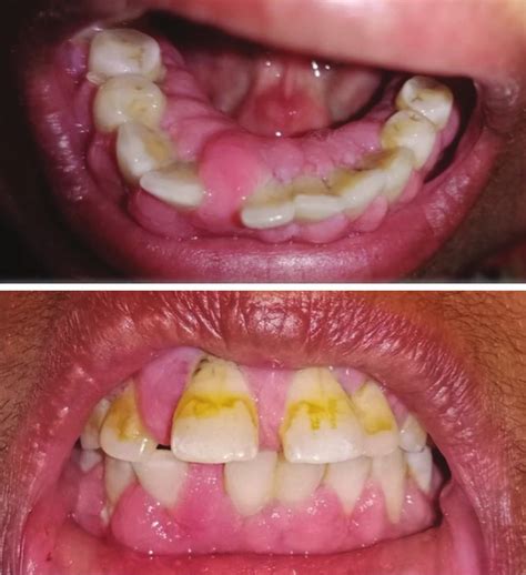Patient Seen On 3 Month Follow Up Download Scientific Diagram