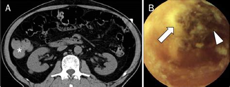 Dynamic Contrast Enhanced Multidetector Row Ct And Capsule Endoscopic Download Scientific