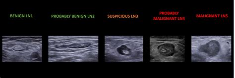 Ultrasound Evaluation Of Inguinal And Pelvic Lymph Nodes Article Glowm