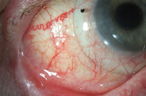 Managing Ocular Cicatricial Pemphigoid Related Osd