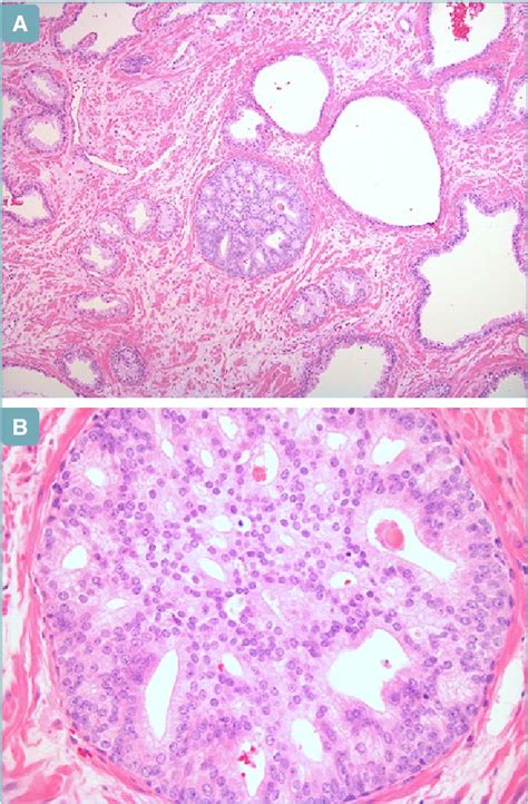 Figure 1 From Prostate Pathology What Is New In The 2022 Who