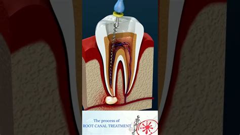 Root Canal Treatment And Tooth Abscess Go It