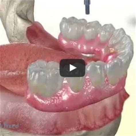 Dinti INTR O ZI Implant Dentar Rapid FAST AND FIXED Preturi