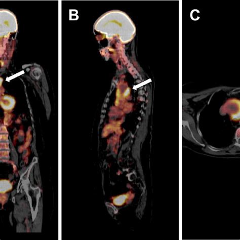 Illustration Of A 72 Year Old Patient With Newly Diagnosed Aortitis Who