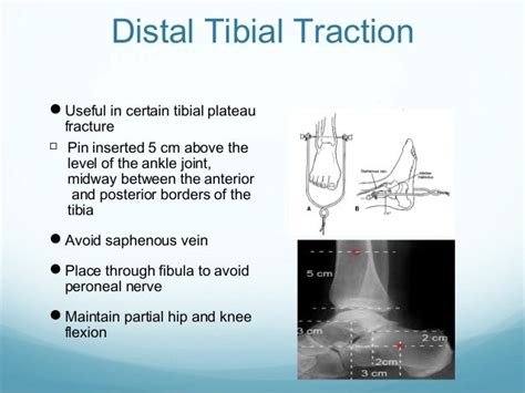 Application Of Traction In Orthopaedics