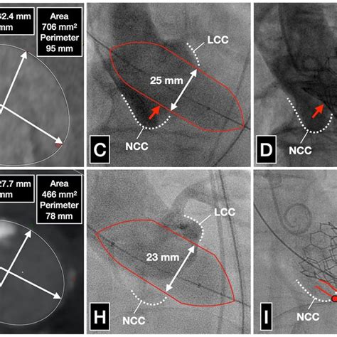 Examples Of Balloon Sizing And Stepwise Deployment During Tavi In