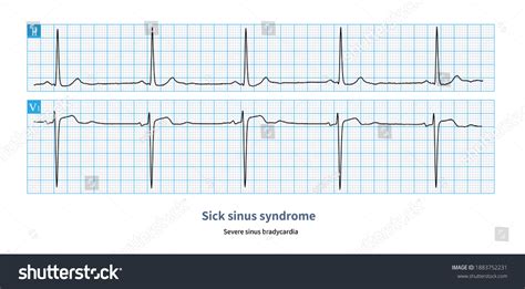 22 Sick Sinus Syndrome Ekg 图片、库存照片和矢量图 Shutterstock