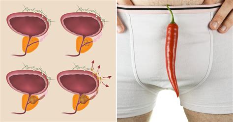 Профилактика простатита у мужчин