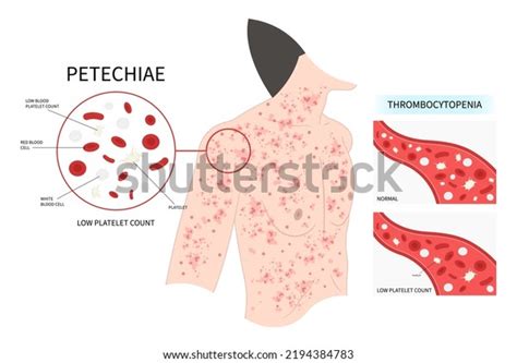 Petechiae Bruise Over 15 Royalty Free Licensable Stock Vectors