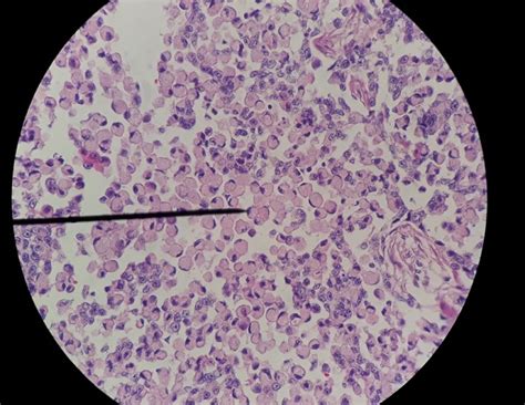 Carcinoma De Células En Anillo De Sello De Glándula Mamaria En Canino
