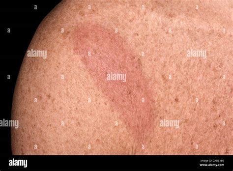 Rash In Lymes Disease On A 58 Year Old Mans Shoulder Lyme Disease Is