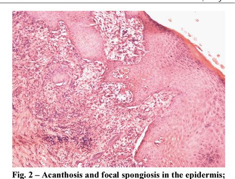 Figure 2 From Atypical Pyoderma Gangrenosum In A Patient With Osteomyelofibrosis Semantic Scholar