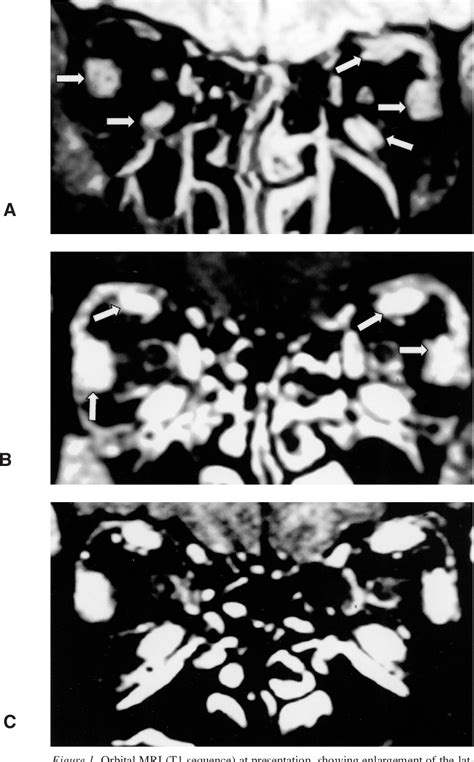 Figure 1 From Bilateral Ocular Myositis As A Late Complication Of