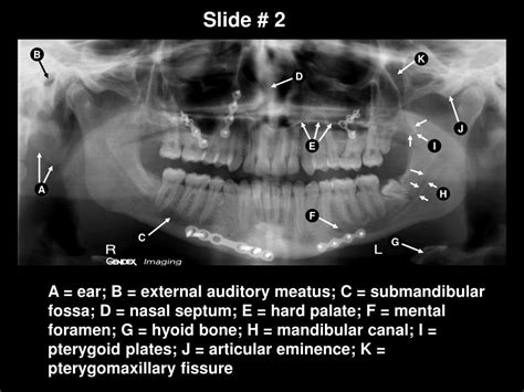 Zygomatic Arch X Ray Positioning Neleryx