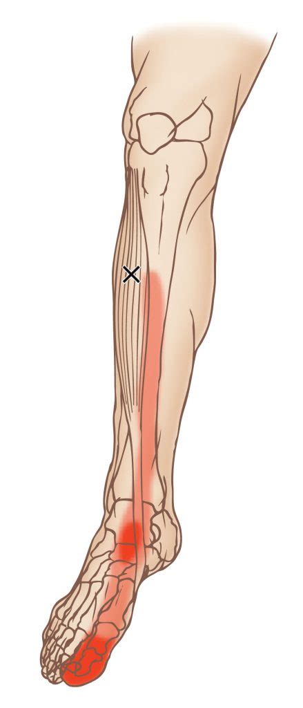 Tibialis Anterior Trigger Point Learn Muscles