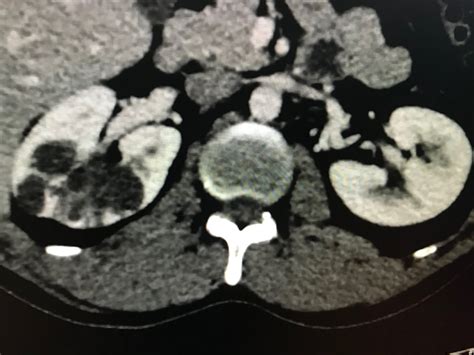 Vietnamese Medic Ultrasound Case 549 Renal Cystic Tumor Dr Phan