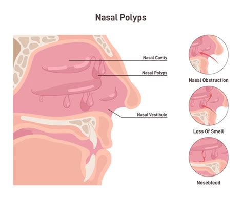 Are Nasal Polyps A Sign Of Cancer Dr Sumit Chattopadhyay