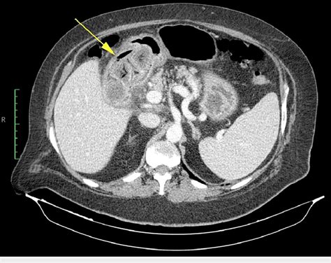 Multiple Gallstones And Air Fluid Level Inside The Gallbladder Arrow Download Scientific
