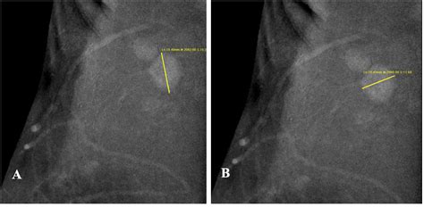 Enhancing Specificity In Predicting Axillary Lymph Node Metastasis In