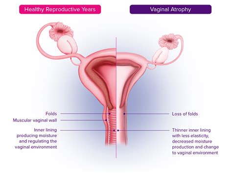 Menopause And Vaginal Discomfort Ovesse 1mg G Vaginal Cream Estriol