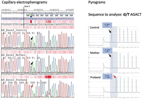 Detection Of Novel Ar Variant By Capillary Sequencing And Download