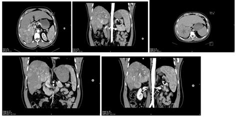 A Triphasic Abdominal Ct Showed Advanced Hcc Ct Liver Arterial Phase