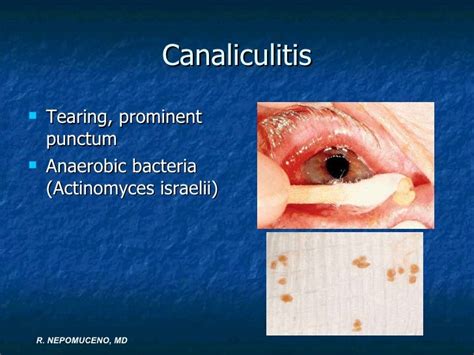 Edandcornea Lecture Fatima