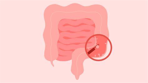 Everything You Need To Know About Colon Cancer Onlymyhealth