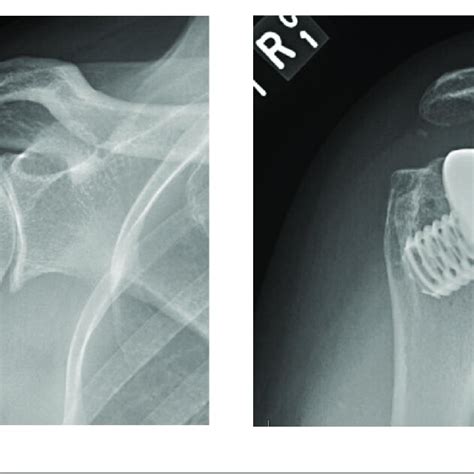 Shoulder X Rays Taken From A Patient With Severe End Stage Arthritis