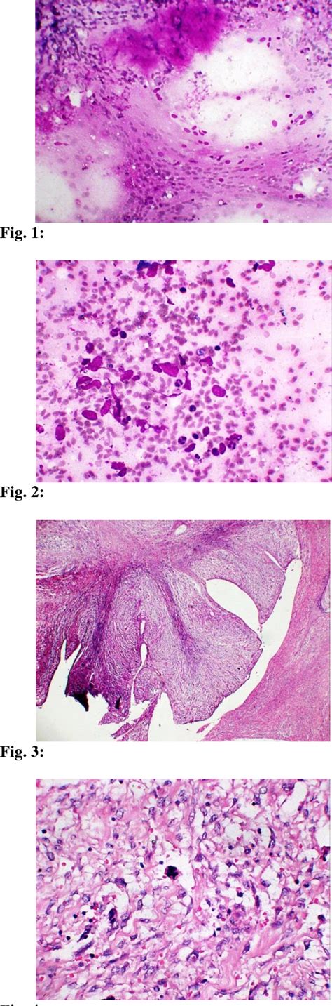 Figure 1 From Phyllodes Tumor Of The Breast Cytohistological Study