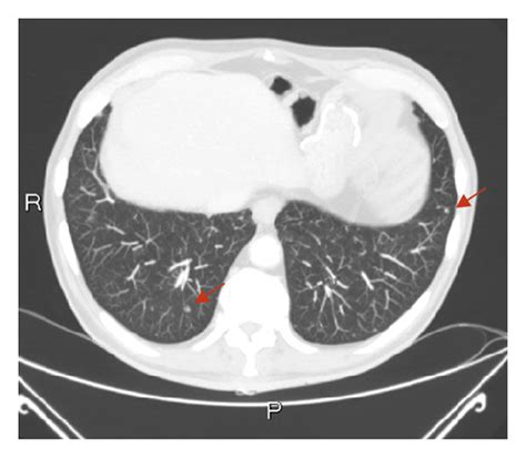 Disease Relapse Radiological Evaluation Of Primary Pancreatic Lesion