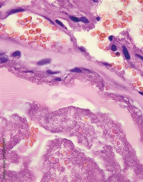 This Photo Shows The Pink Myxoid Stroma Of An Atrial Myxoma With Cords Of Myxoma Cells And