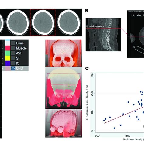 Measurement Of Hounsfield Unit In Skull And Lumbar Bone And Their