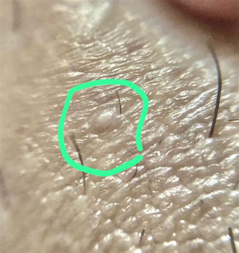 Grânulos De Fordyce Na Genital Braincp